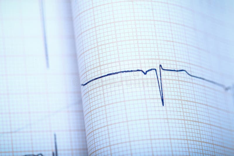 Close-up of Heart Complex on ECG Paper Stock Photo - Image of file ...