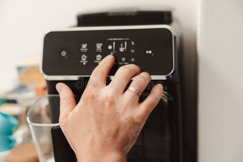 Close Up of a Human Hand with Spots of Vitiligo Disease Operating ...