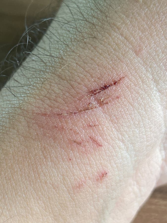 Human hand with a wound stock image. Image of bruise - 310279203