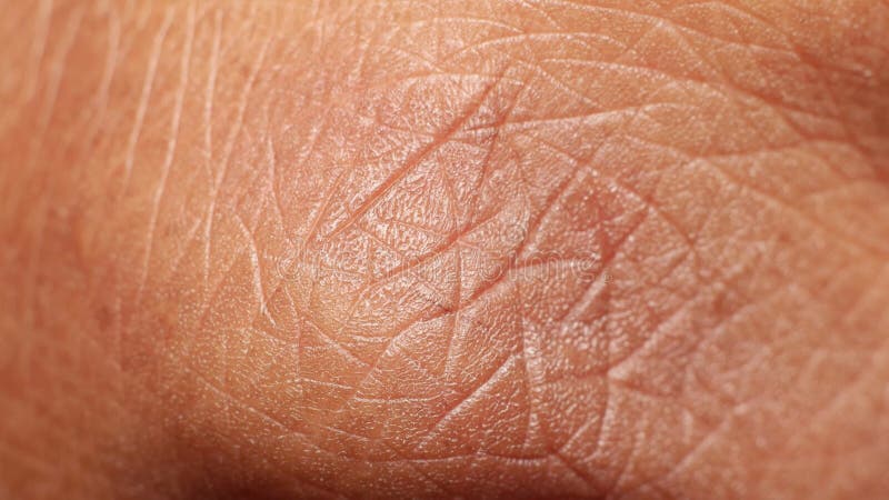 Human Skin Disease. Persons Hands Swathe with Bandage, Around Scars ...