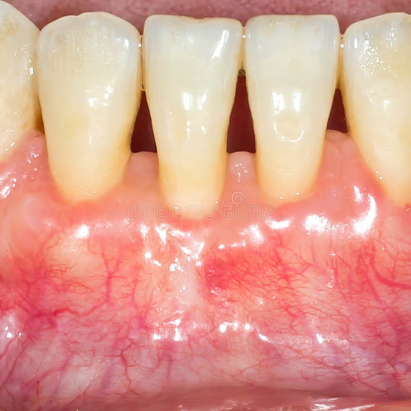 Close-Up of Human Teeth with White Spots Stock Image - Image of dentin ...