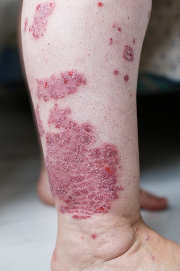 Close Up Ill Allergic Rash Eczema Skin Of Patient Atopic Dermatitis