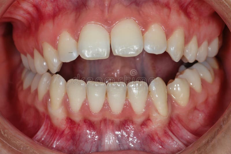 Close-Up of a Persons Teeth Stock Photo - Image of teeth, healthcare ...