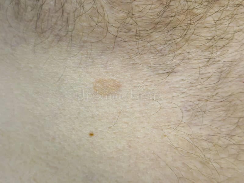 Close-up Image of Skin Showing a Mole and Hair Stock Image - Image of ...