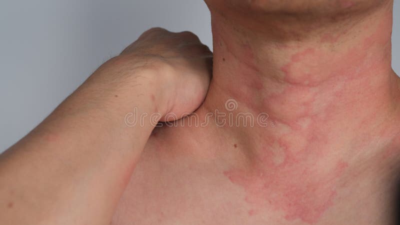 Close Up Skin Hives or Kaligata on Back. Stock Photo - Image of ...