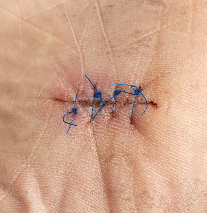Close up image of sutures stock image. Image of incision - 35335019