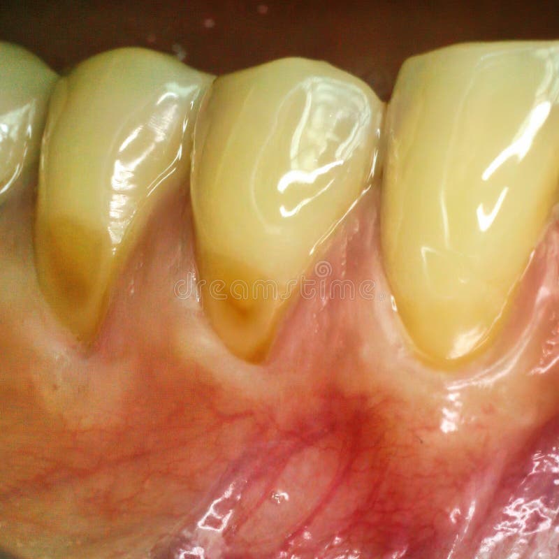 Yellow Stain On Your Teeth Stock Photo Image Of Denture Discolored