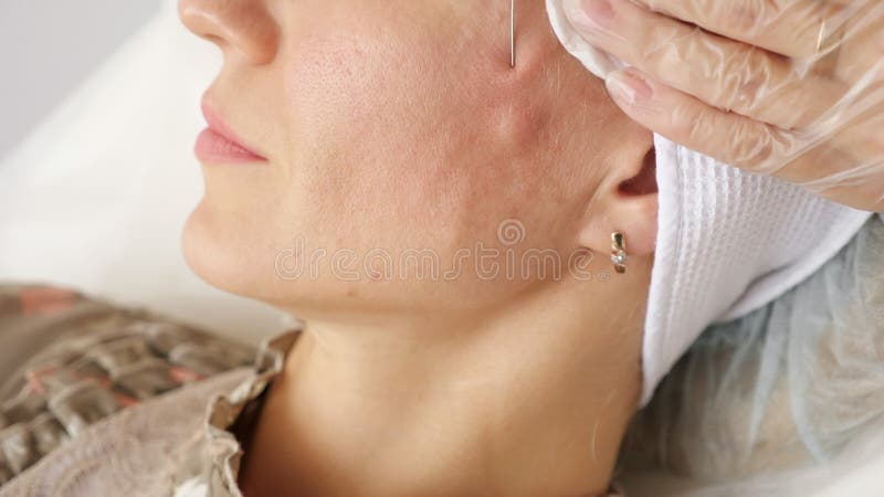 Close-up of Inserting a Needle Under the Skin of a Woman`s Face Stock ...