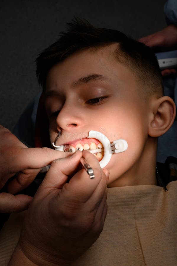 Close Up of Installing Braces on Teeth, Aligning Teeth with Braces ...