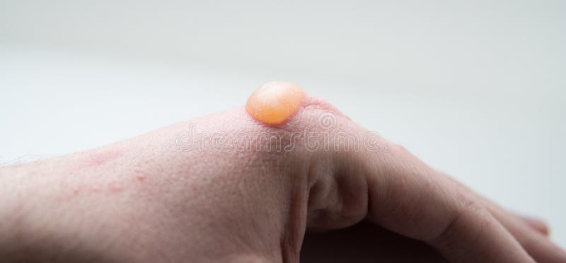 Blister on a hand stock photo. Image of blister, medical - 113949810
