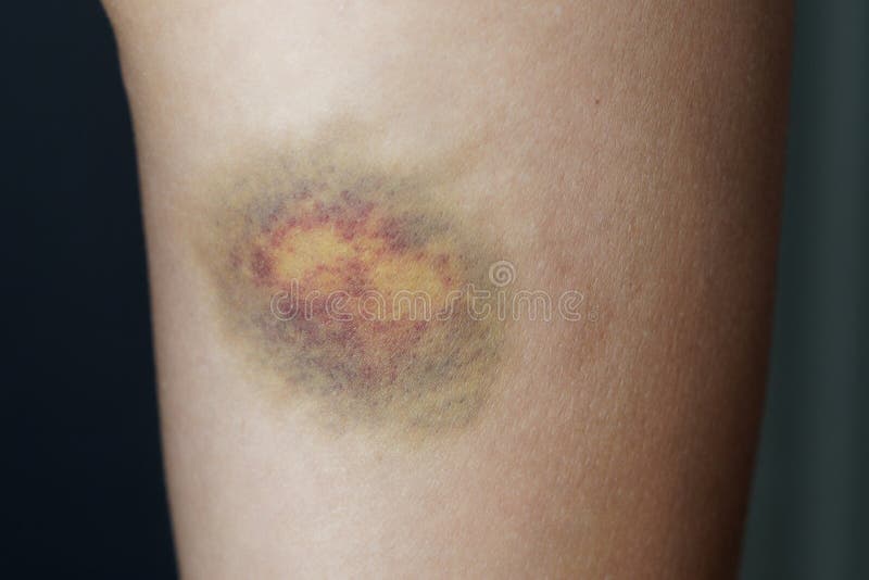 Large bruise on human arm stock image. Image of sore - 227801671