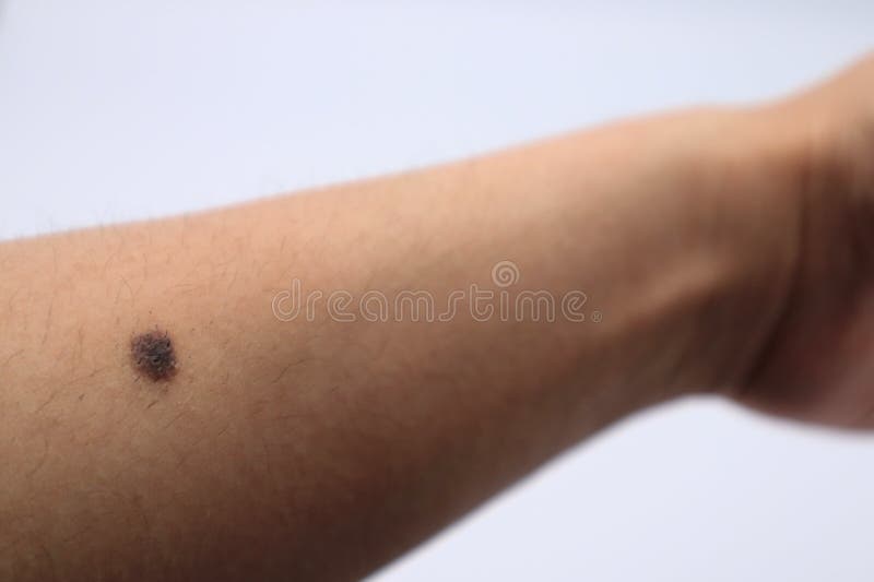 Close Up of Large Mole on Arm Stock Photo - Image of close, trouble ...