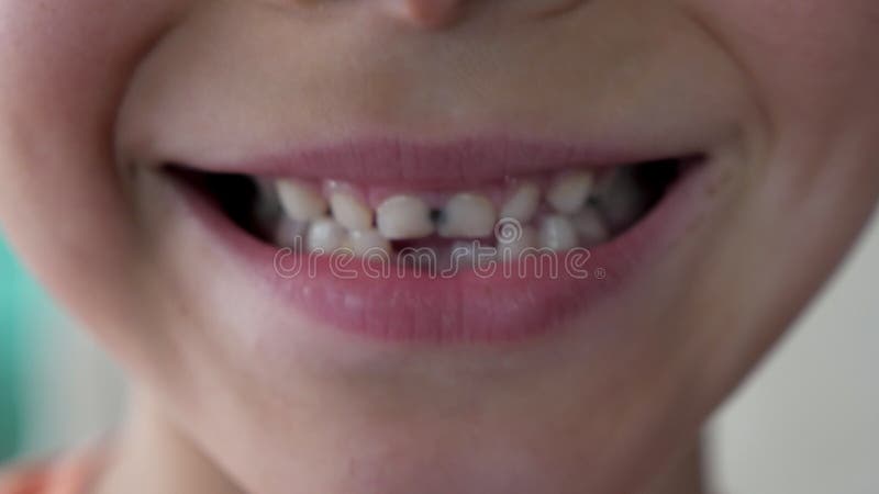 Close Up Little Child Show Broken Teeth Boy with a Teeth Broken and ...