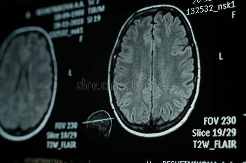 Close-up of Magnetic Resonance Imaging of the Human Brain Stock Image ...