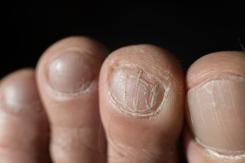 Close-up of Male Toes with a Cracked Nail Stock Image - Image of bare ...