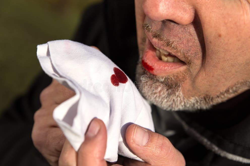 Close Up, Man with Bloody Tissue Stock Image - Image of gums, tissue ...