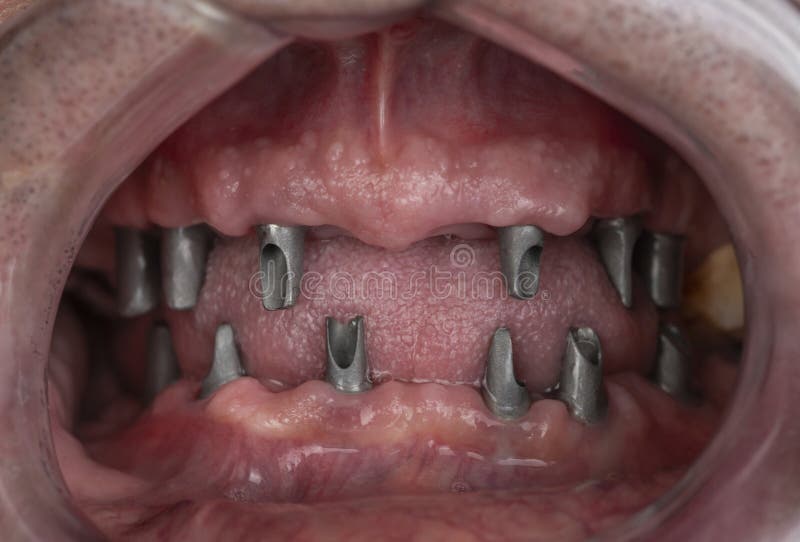 Man Cavity Protected by Retractor Showing Perfect Teeth.implants and ...