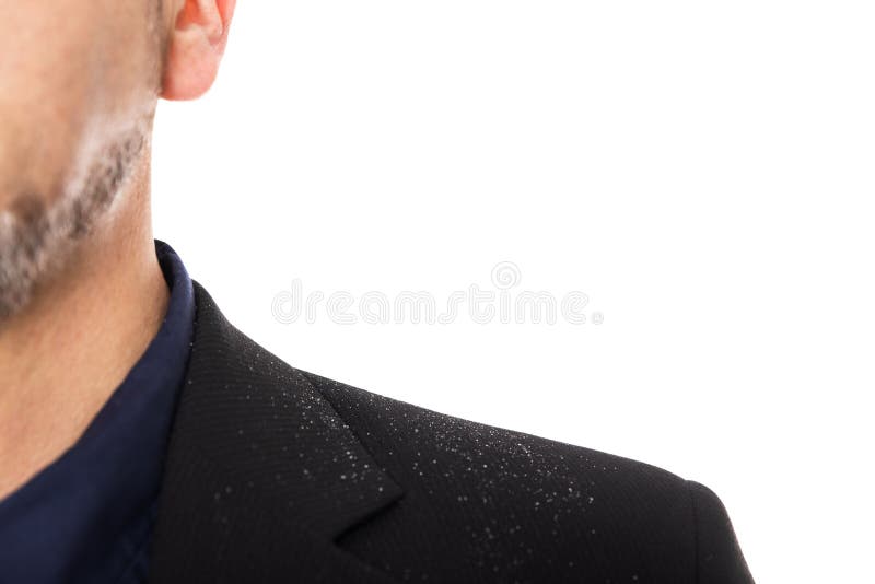 Close Up from a Man with Dandruff Stock Photo - Image of skincare ...