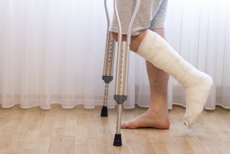 Close-up of Man Leg in Plaster Cast Using Crutches while Walking. Stock ...