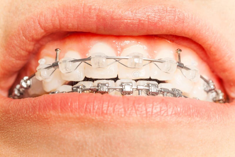 Close-up of Man Mouth with Tooth Correction Braces Stock Image - Image ...