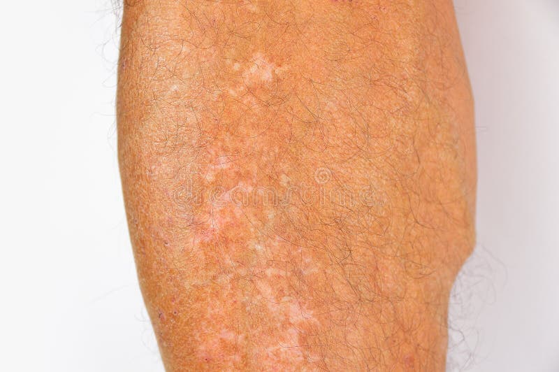 Hyperpigmentation On Legs