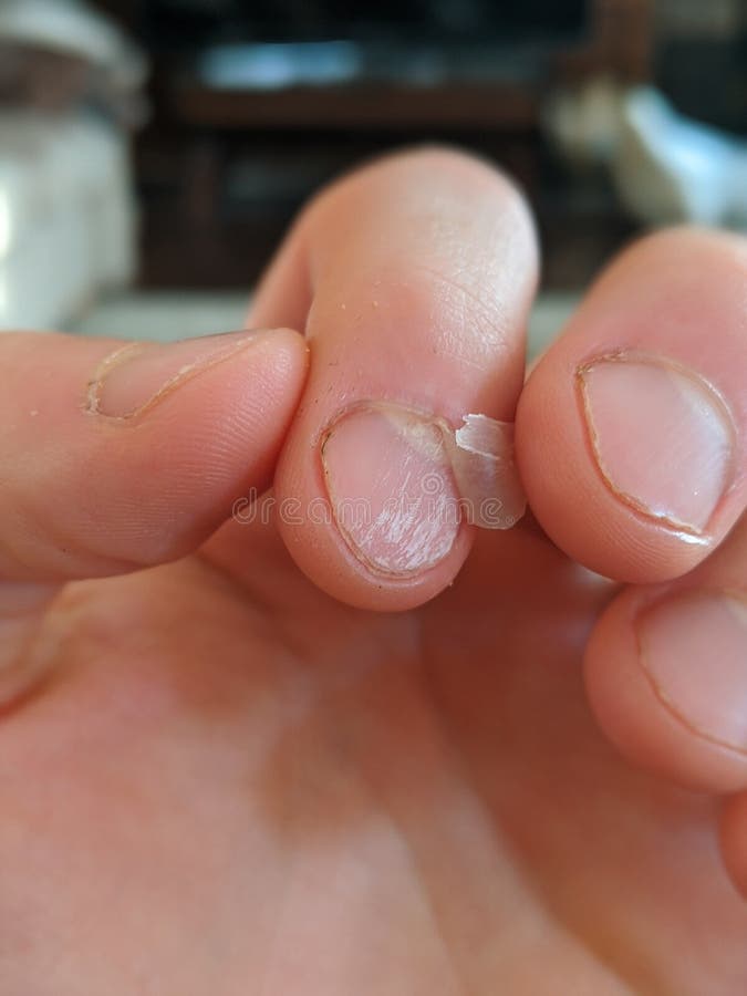 A fingernail peeling off stock photo. Image of peeling - 313826896