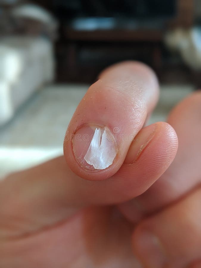 A fingernail peeling off stock photo. Image of scratched - 313826902