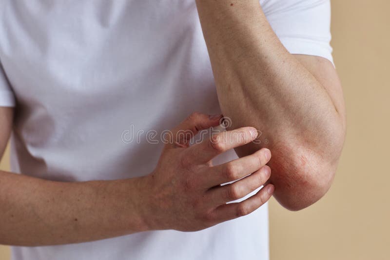 Close Up of Man Scratching Elbow Rash or Skin Condition Stock Photo ...