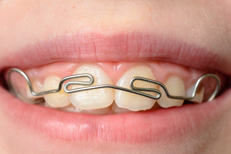 Close-up of a Metal Plate in the Mouth on the Teeth of a Little Boy ...