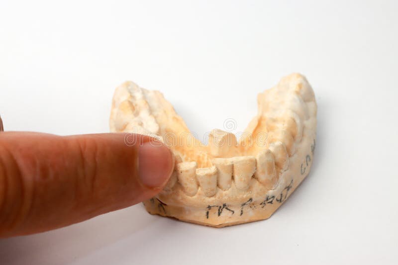 Close Up of an Mold of a Man’s Lower Teeth Stock Photo - Image of tooth ...