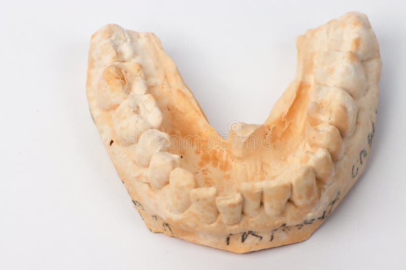 Close Up of an Mold of a Man’s Lower Teeth Stock Image - Image of ...