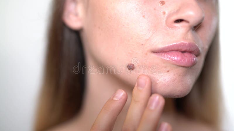 Close up mole on the face stock footage. Video of woman - 263421166