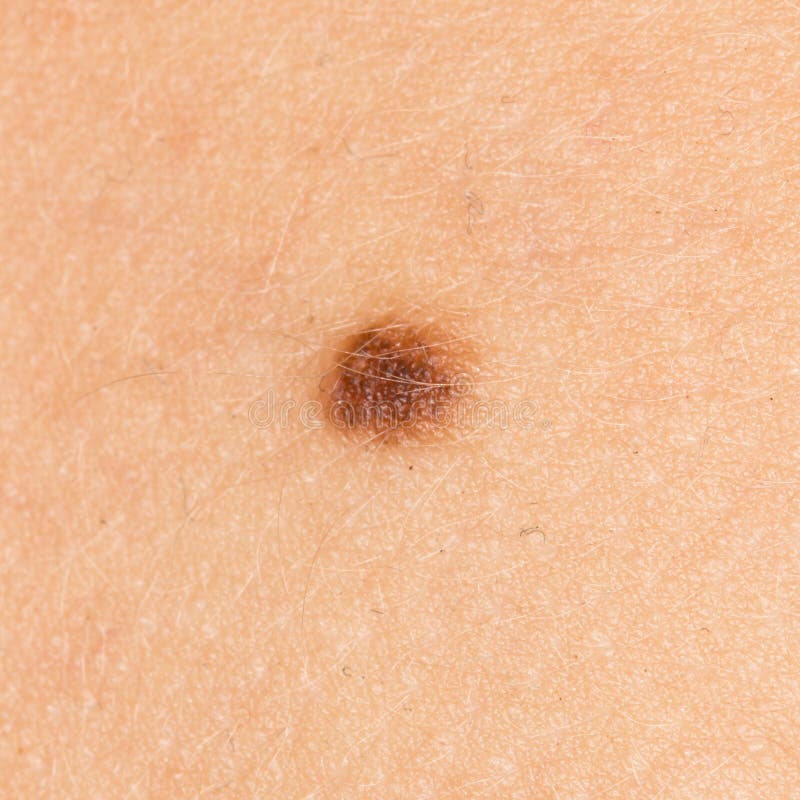 Close Up of Mole on Human Skin Stock Photo - Image of beauty, spot ...