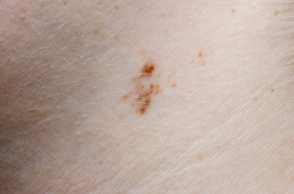 Close-up of a Mole on Human Skin Stock Photo - Image of dermatological ...