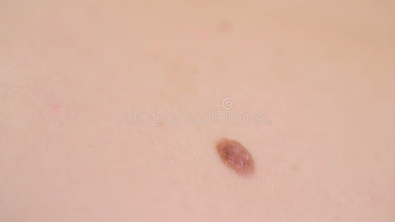 Large Birthmark on the Arm Close-up. the Capillaries are Close To the ...