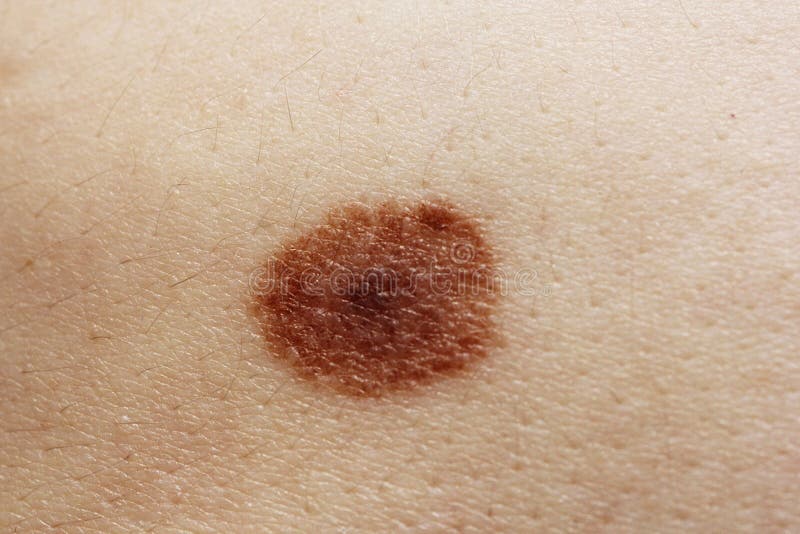 Large mole stock photo. Image of closeup, mole, freckle - 38367118