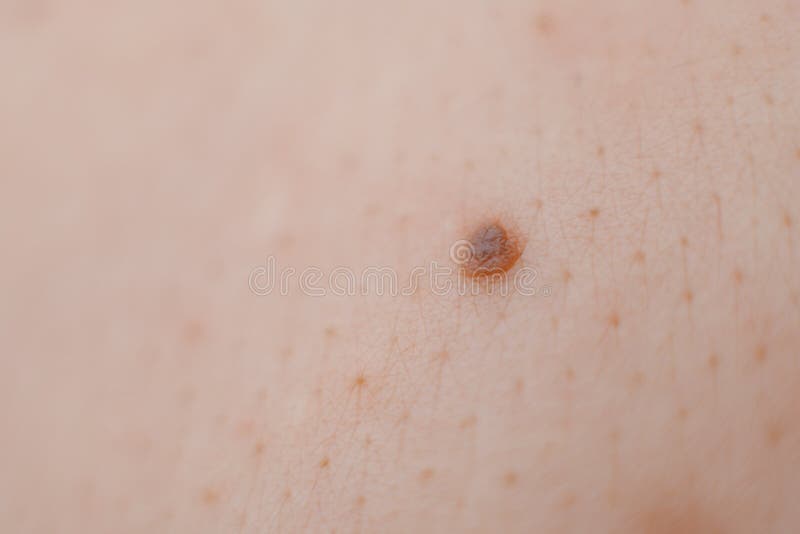 Nevus or Mole on the Human Body Close-up. Skin Cancer, Keratosis or ...