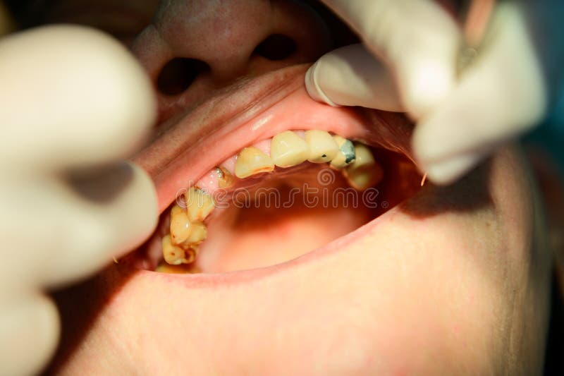Close-up Mouth To Showing Cavities Teeth Decay Stock Image - Image of ...