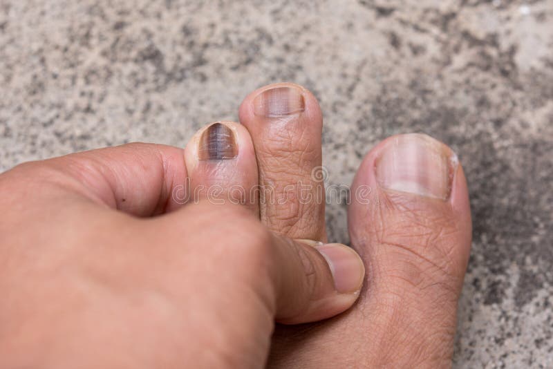 Nail Infections Caused by Fungi Such As: Onychomycosis Also Known As ...