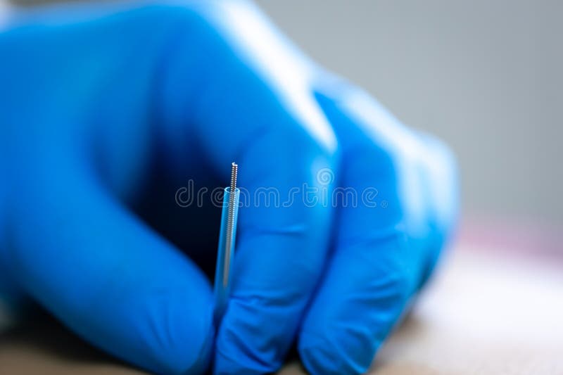 Close Up of a Needle and Hands of Physiotherapist Doing a Dry Needling ...