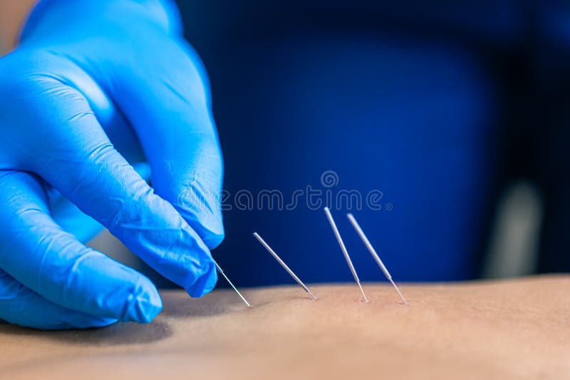 Close Up of a Needle and Hands of Physiotherapist Doing a Dry Needling ...