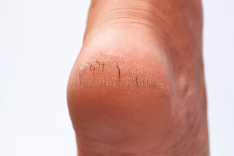 Close-up of a Person S Cracked Heels Stock Photo - Image of depilation ...