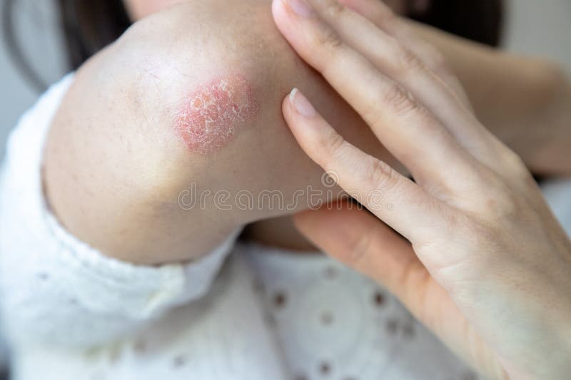 Close Up Of A Person Touching A Red Dry Patch Of Skin On Their Elbow
