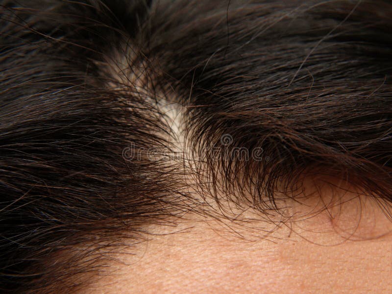 Dry Itchy Dandruff Scalp with Scabs on Woman`s Head with Hair Stock ...