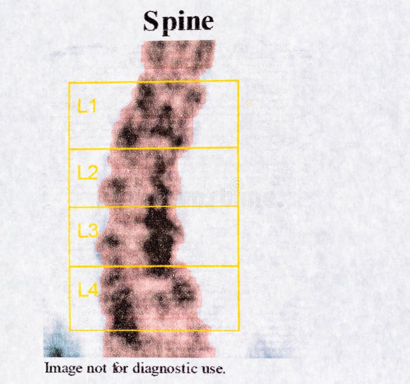 Good Spine Bone Density Test