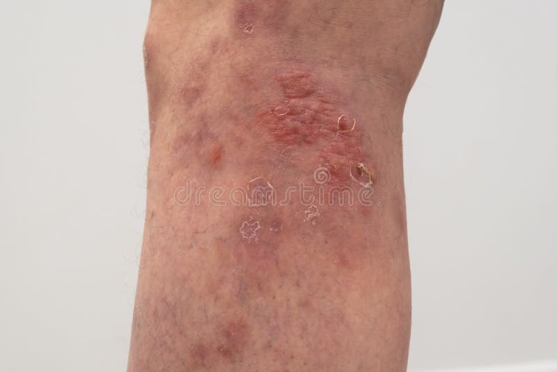 Close Up Photo of Leg with Psoriasis. Stock Photo - Image of problem ...