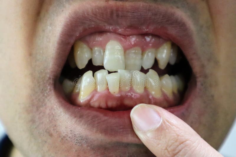 Close-up Photo of a Person with Crooked Teeth Stock Image - Image of ...