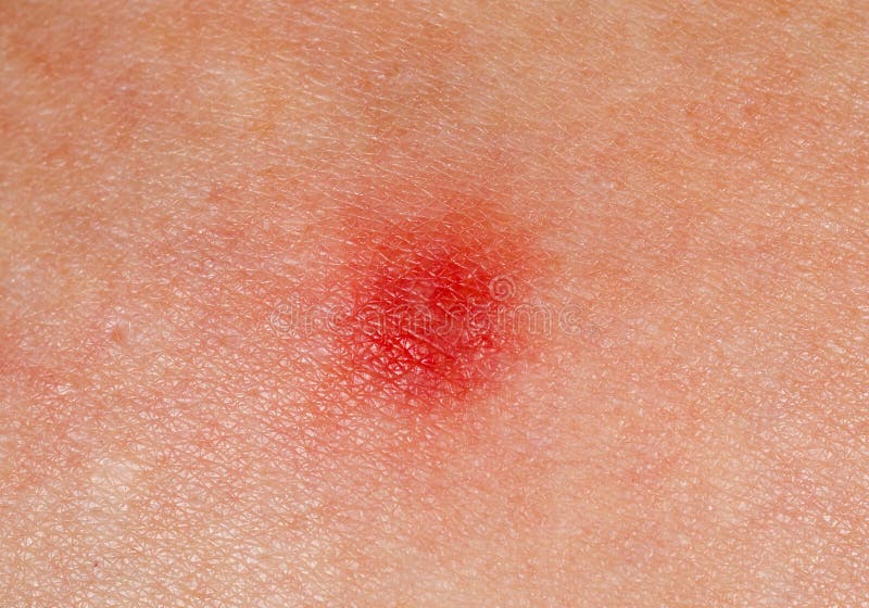 Red patch on human skin stock photo. Image of disease - 179120706