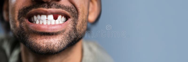 Photo of Young Man with Missing Tooth Stock Image - Image of closeup ...