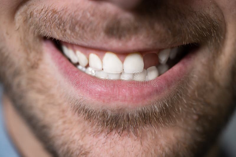 462 Man Missing Tooth Stock Photos - Free & Royalty-Free Stock Photos ...